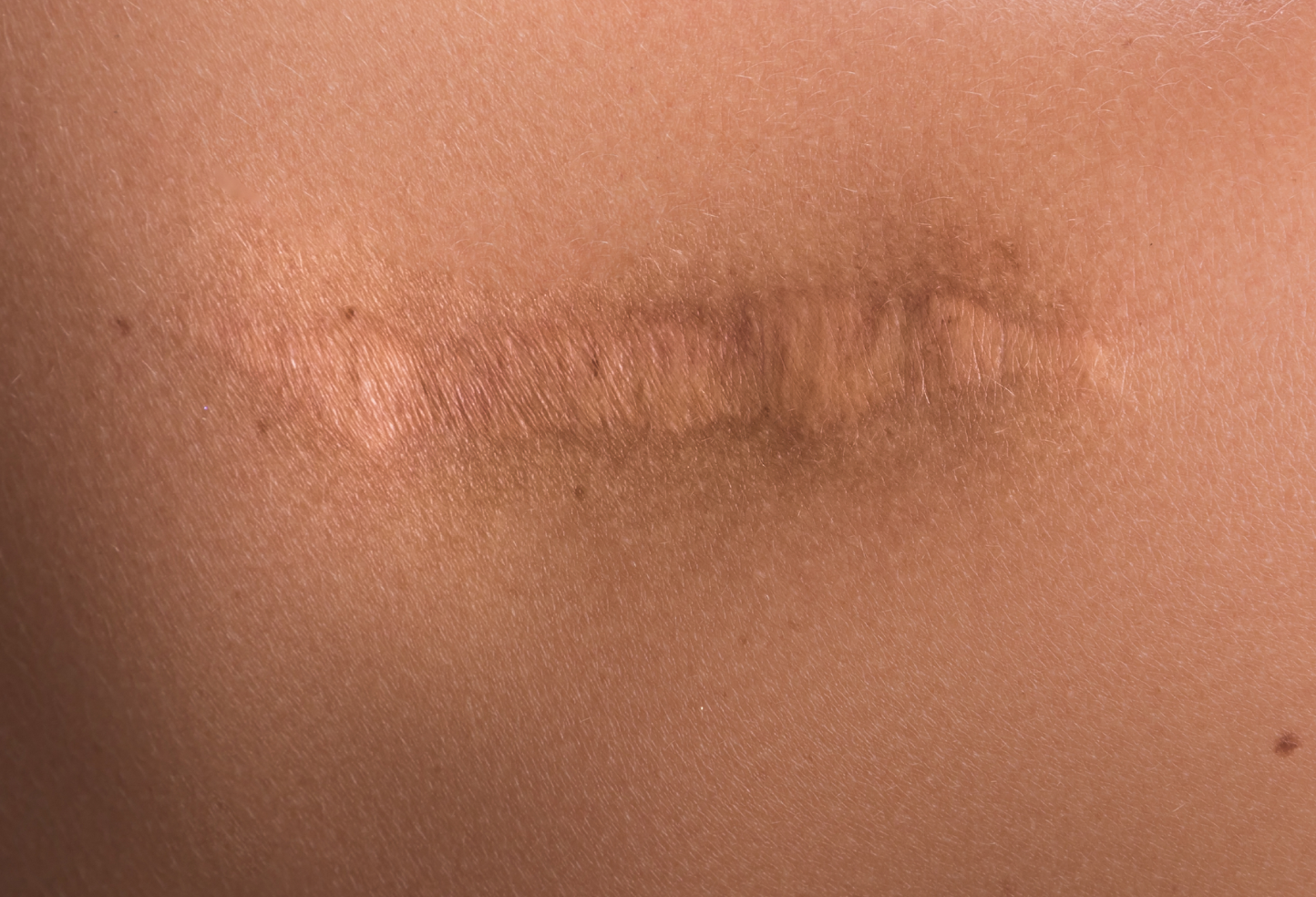 Can You Wear A Bra After Shoulder Replacement Surgery? – Springrose